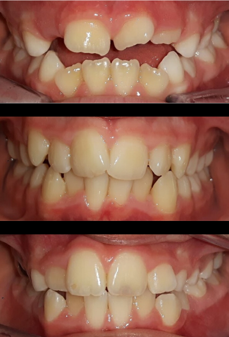 Childrens Orthodontics | Dental Blog - Aura Dental