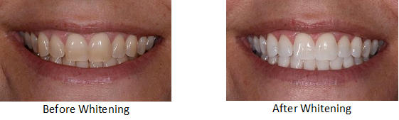 How Teeth Whitening Can Improve Your Confidence | Dental Blog - Aura Dental